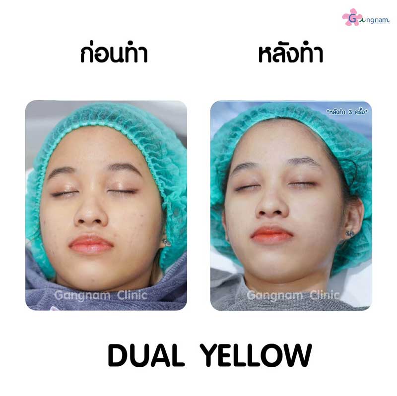 ผู้หญิง - Dual Yellow Laser เคลียร์ปัญหาผิวหน้าดำคล้ำ ฟื้นฟูผิวให้ใส ...